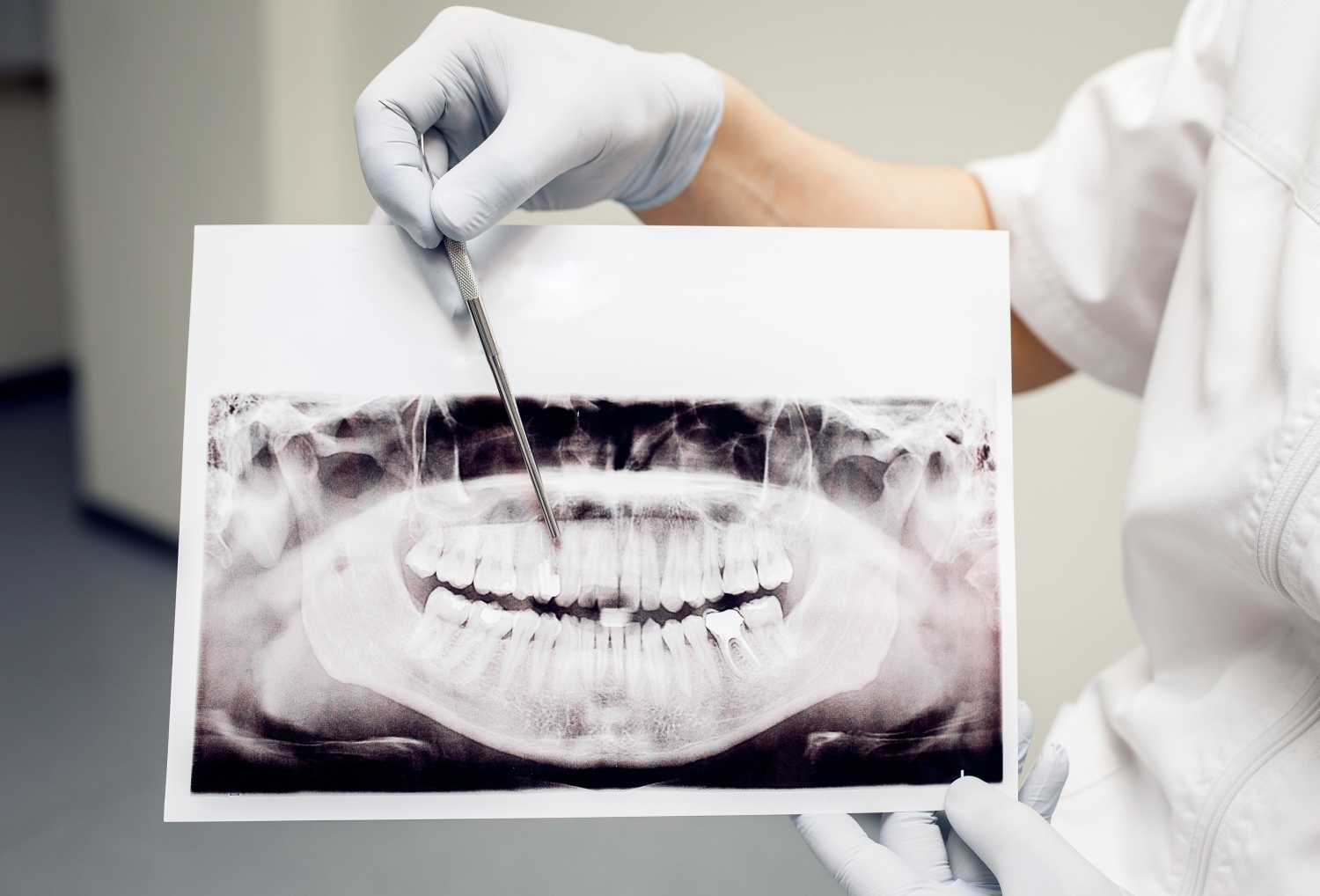 Las 5 fases de la caries - Arco Clínica Dental
